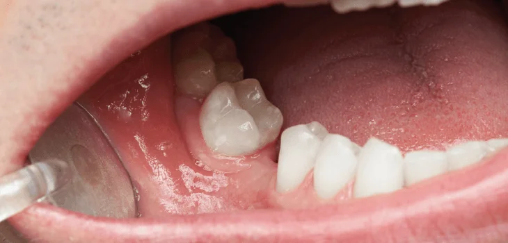 5 ways to know when you may need dentures