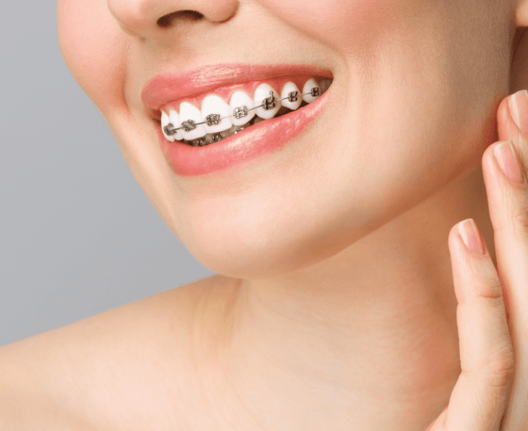 Braces and Adult Specific Braces | AP Smilecare | Contact Us