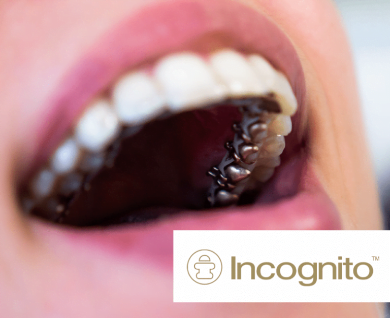 Incognito Braces | Hidden Teeth Braces | AP Smilecare